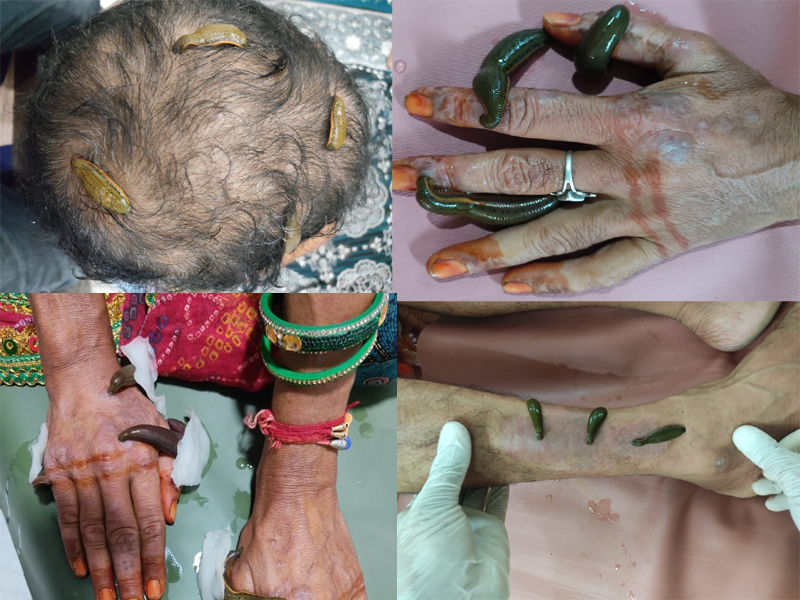 Leech Therapy Treatment and Procedure » Devkalp Ayurveda